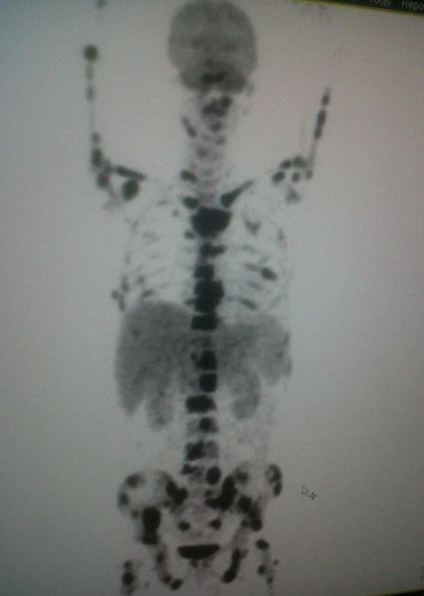 Superscan Phenomenon - Sumer's Radiology Blog