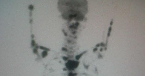 Superscan Phenomenon - Sumer's Radiology Blog