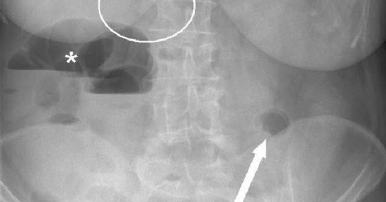 Pneumobilia Pain - Symptoms, Causes, Treatment, Ultrasound - Health ...