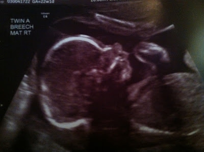 LuvLaughPray: 22 Wks Follow-Up Ultrasound / Random Info / Sexy Brace