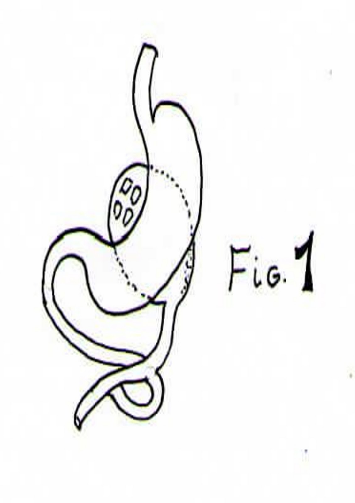 Tratamento Cirurgico Heterodoxo de Empiêma Pleural Pós Pneumonectomia ...