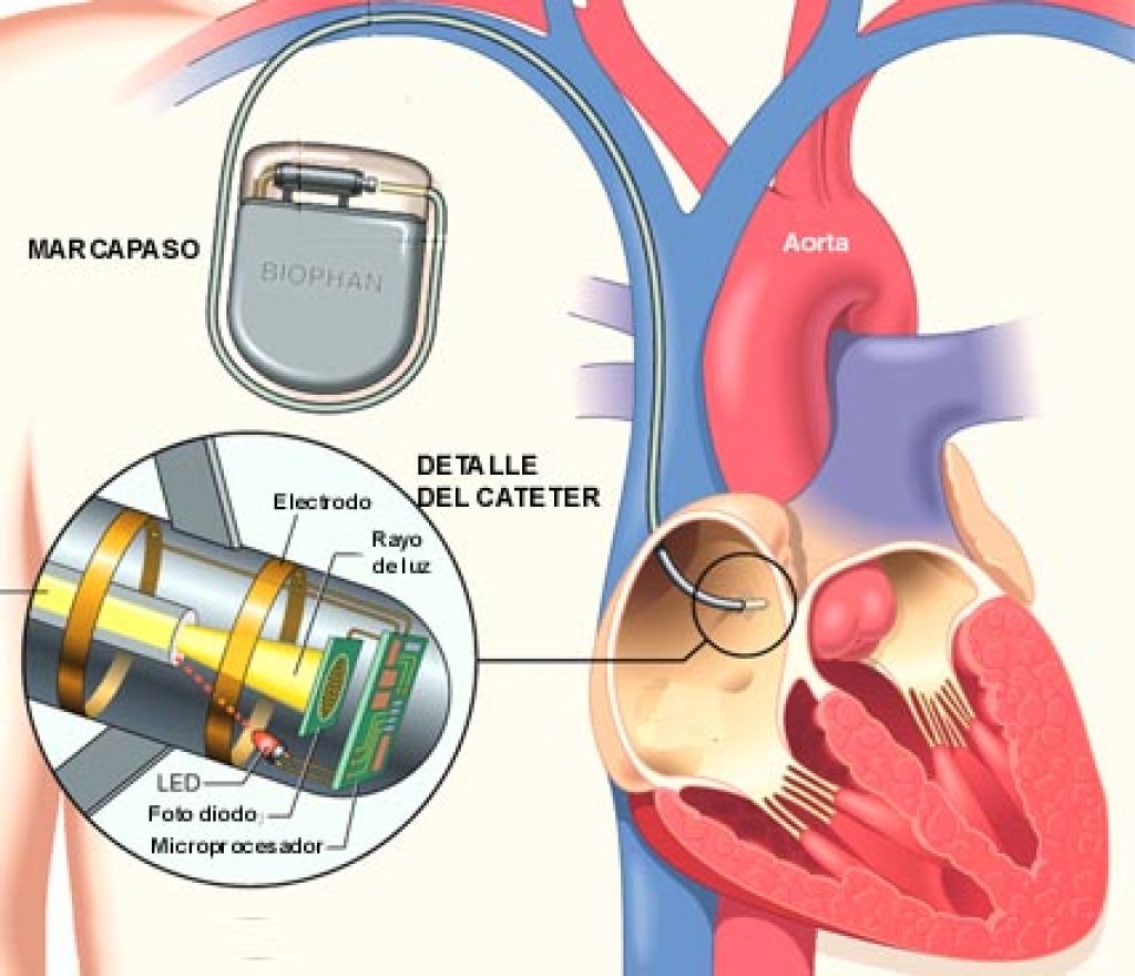 Colombiano Inventor del Marcapasos