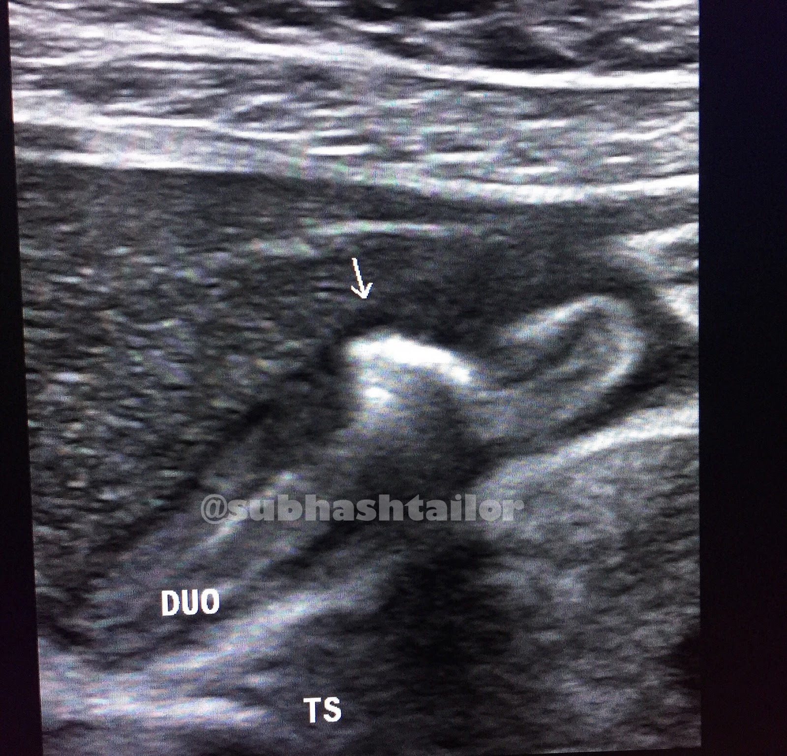 SONO DIGEST: DUODENAL USG