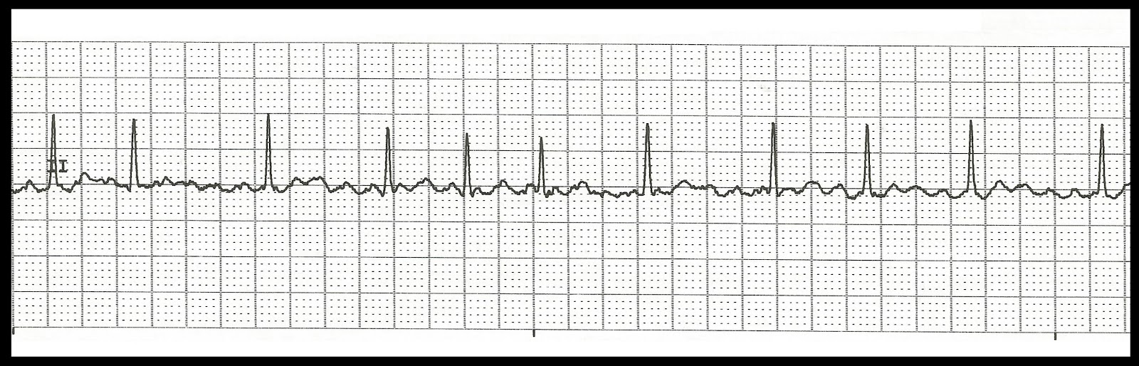 Atrial Fibrillation Rhythm Strip Atrial Fibrillation Irregular