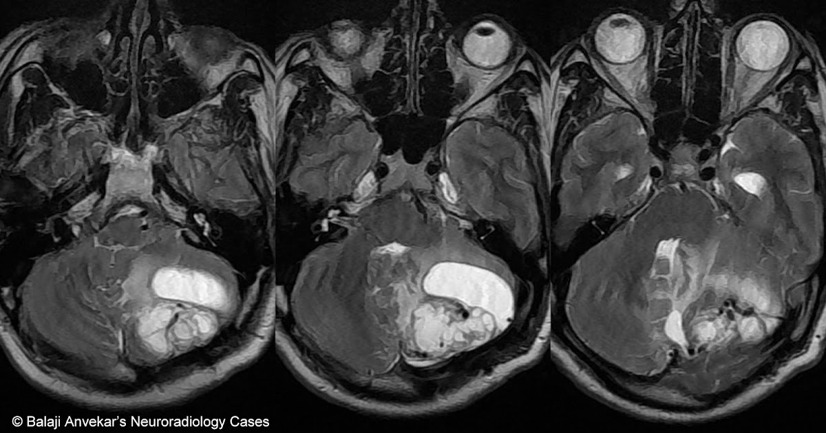 Neuroradiology Cases: Hemangioblastoma MRI