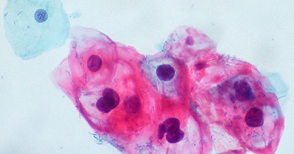 Koilocytosis - Symptoms, Causes, Histology, Treatment - Health Care ...