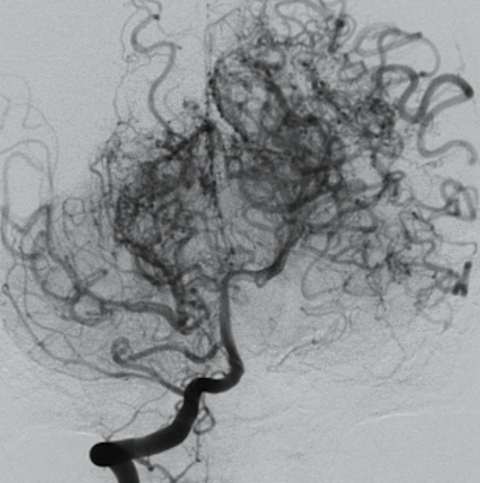 what is moyamoya disease Moyamoya disease - Diseases Club center