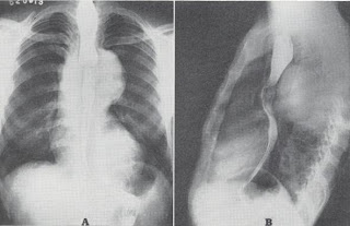 Cardiovascular syphilis