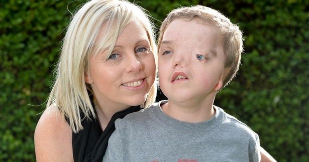 Cruel bullies call 12-year-old boy born with half a face a 'Halloween ...