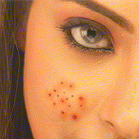 HEALTH AND FITNESS: Pimples care