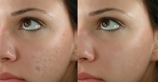 Removing Pimple and Blemishes Skin in Pixlr Editor - Editphotoline