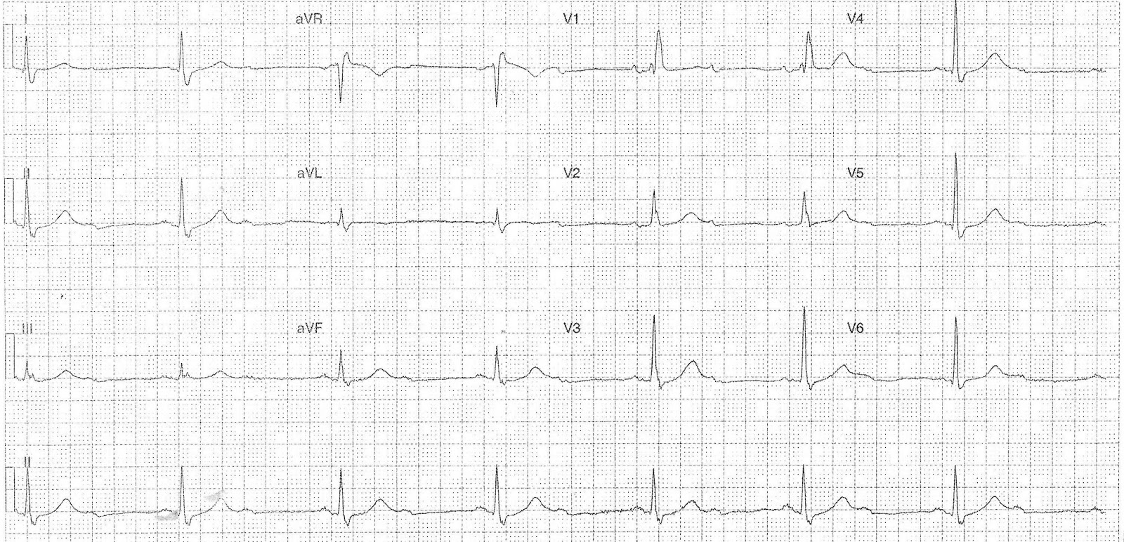 ECG of the Week: ECG of the Week - 14th May 2018 - Interpretation