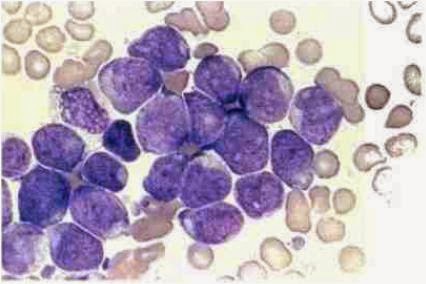 Atlas Células Sanguíneas : LEUCEMIAS MIELOIDES AGUDAS