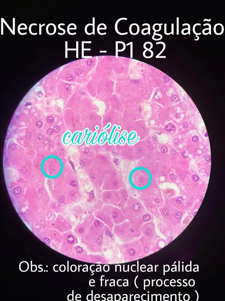 HISTOLOGIA90: TIPOS DE NECROSE