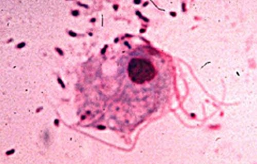 La Tricomoniasis | Remedios Caseros