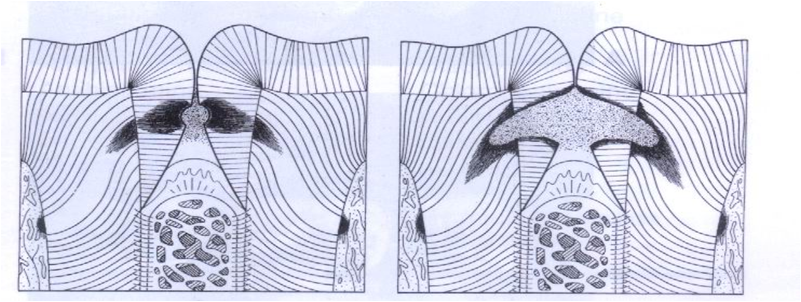 Dentistry and Medicine: Dental Caries definition, Classification of ...
