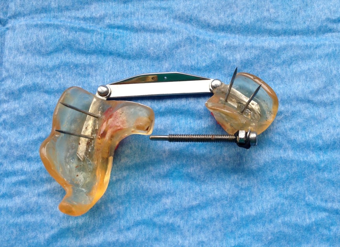 Unidad Funcional del Fisurado: Ortopedia Prequirúrgica