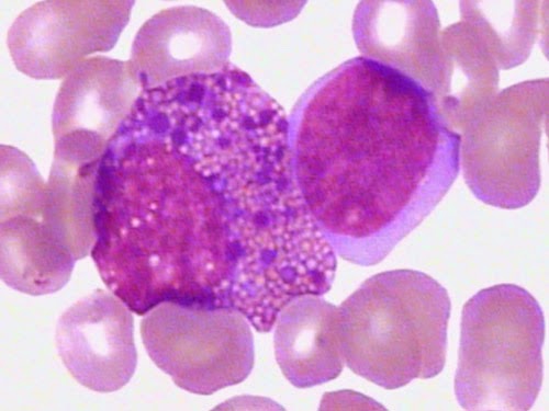 Fichero Hematología : Leucemias Mieloides Agudas (Clasificación FAB)