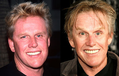 Gary Busey Plastic Surgery Before and After Facelift and Eyelid Surgery ...