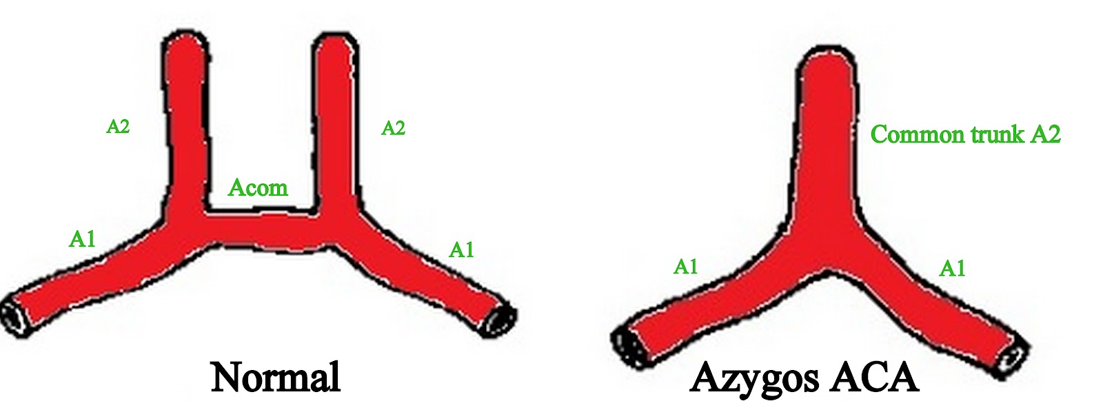 Dr Balaji Anvekar FRCR: Azygos ACA