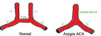 Dr Balaji Anvekar FRCR: Azygos ACA