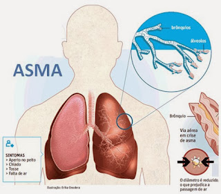 Jenis-jenis Penyakit Asma | Kesehatan: Tips Sehat & Masalah Kesehatan
