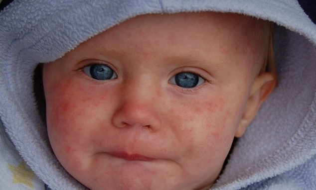 Measles Disease In Babies, Recognize Symptoms & How to Cope It - Life ...