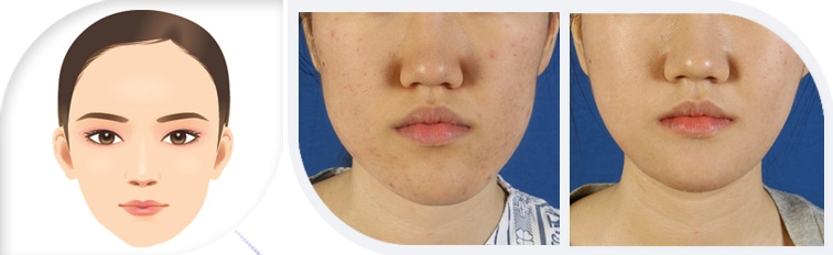 BK Plastic Surgery: [BK Plastic Surgery] Facial bone contouring: Facial ...