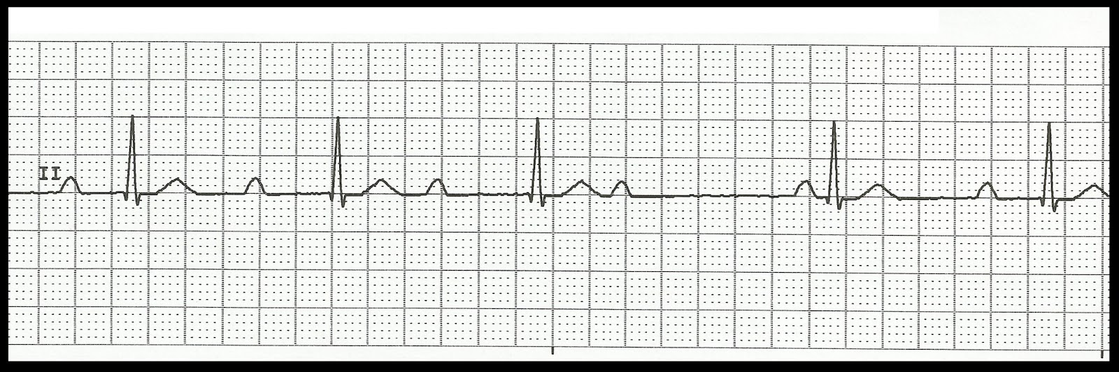 Float Nurse: Practice EKG Rhythm Strips 171