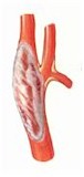 Doctors Gates: Simple illustrations of Carotid Endarterectomy Procedure