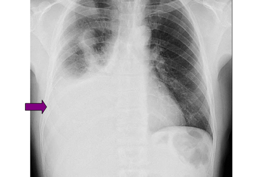 Best Practices: Tube Thoracostomy Insertion ~ Medica Chemistry