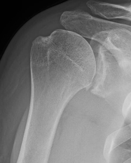 Shoulder Arthritis / Joint Replacement : Post arthroscopic focal ...