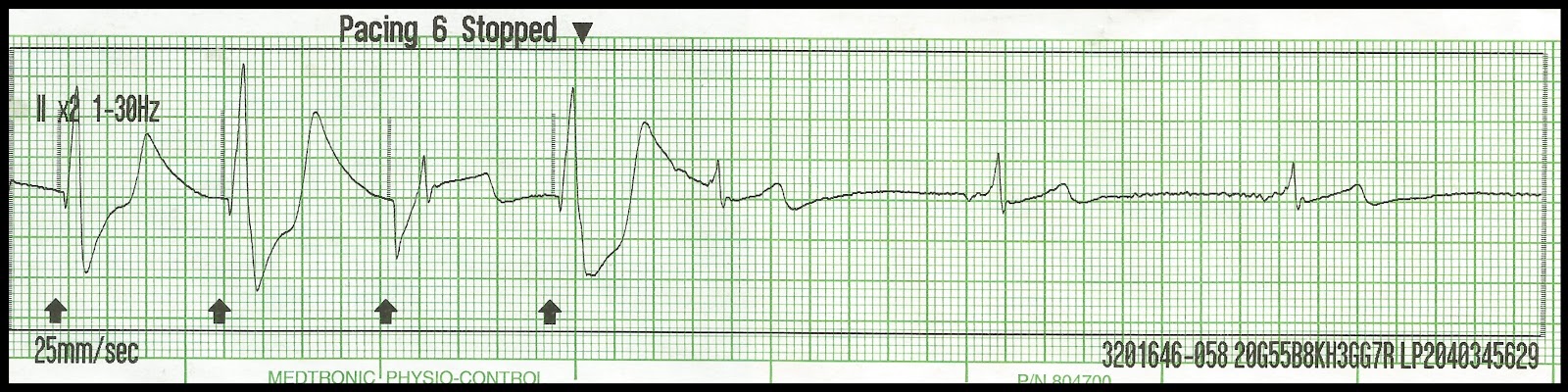 Unstable Bradycardia Part 1 (Beta-blocker toxicity)