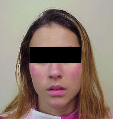 Fisioterapia e Saúde: LÚPUS ERITEMATOSO SISTÊMICO – LES