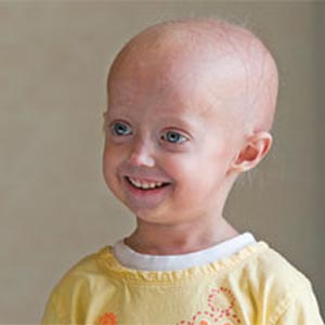 hutchinson-gilford progeria syndrome ~ Christine O'Donnell
