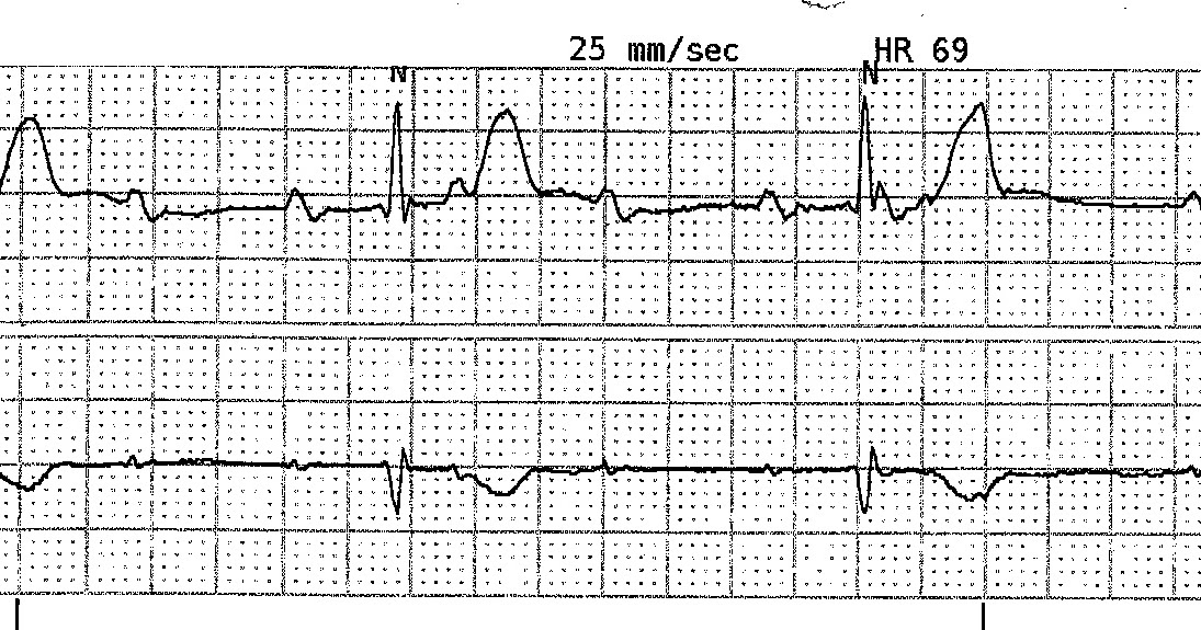 Ecg Rhythms Atrial Tachycardia And Av Block