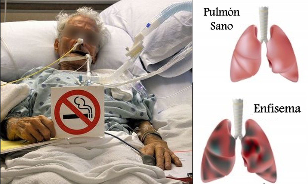 Que Es Un Enfisema , Enfisema pulmonar: causas, síntomas y tratamiento ...