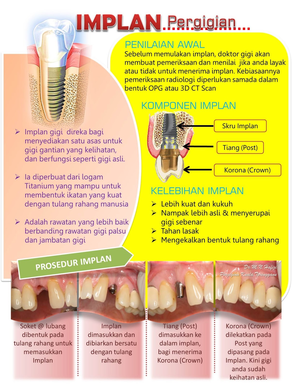 Healthy Mouth For All: Implan Pergigian