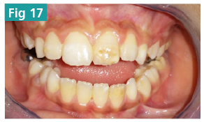 Molar Incisor Hypomineralization (MIH): Conservative Treatment Approach