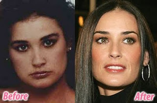 Demi Moore Plastic Surgery Before and After Breast Implants and ...