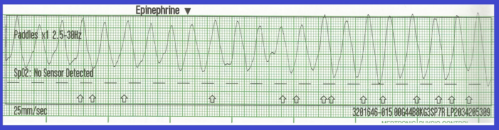 Code Blue: Sudden Cardiac Arrest