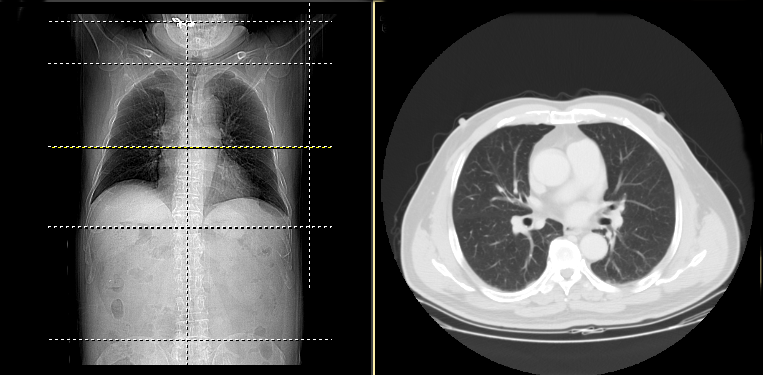 CXR 胸部x光判讀 nipple