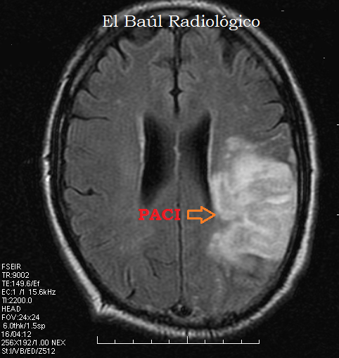 El Baúl Radiológico: ICTUS: UN GALIMATÍAS DE SIGLAS (Stroke: A ...