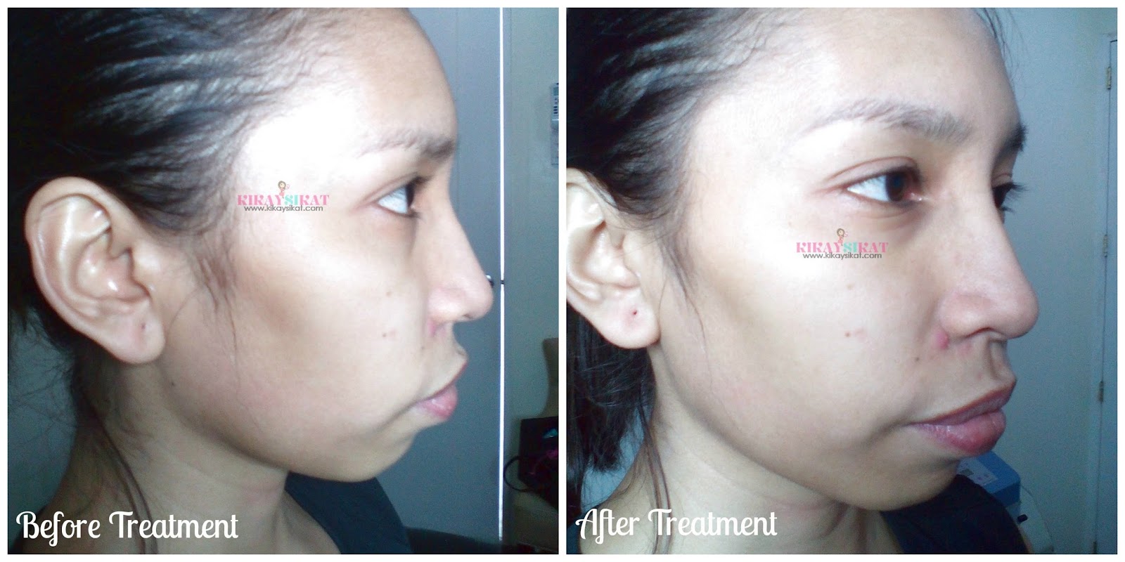 Review: Pollogen Legend Treatment - My Experience - KIKAYSIKAT