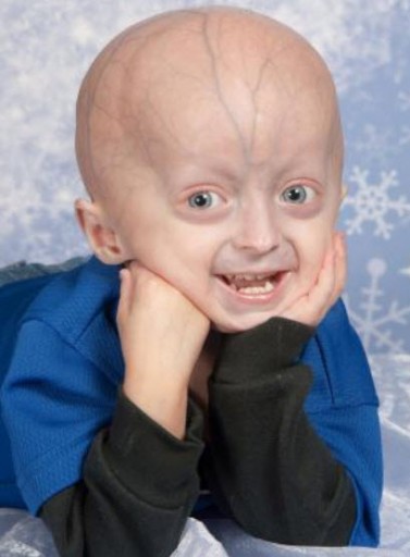 Enfermedades Raras: Síndrome de Hutchinson-Gilford (progeria) Enfermedades Raras: Síndrome de Hutchinson-Gilford (progeria)