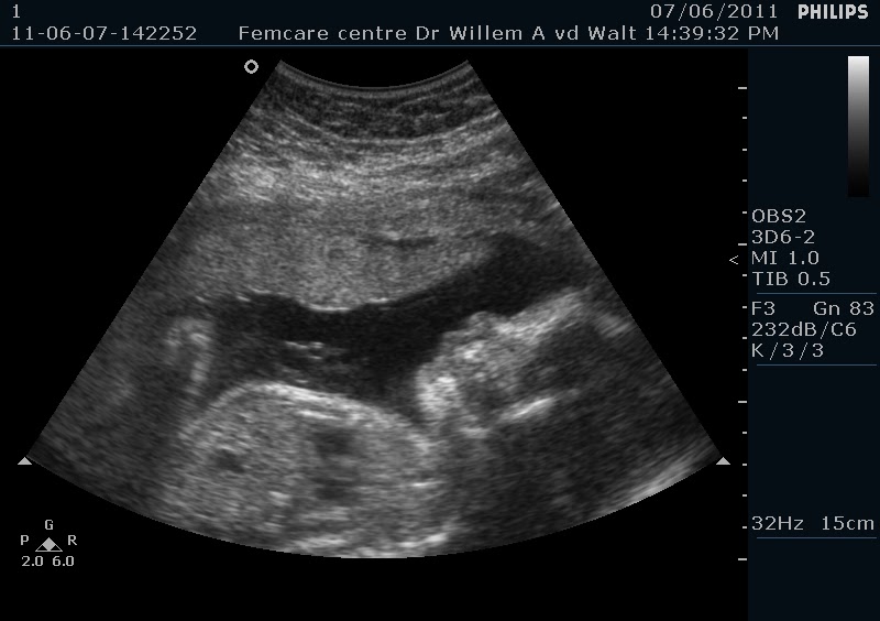 Pregnant Princess: 26 week scan and 4D scan