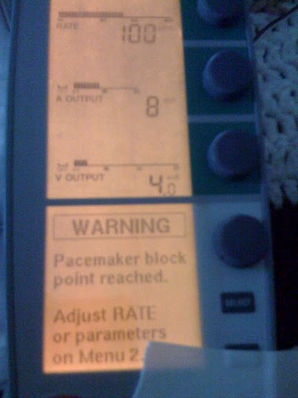Pedi cardiology: EP & ICU: Concept of PMT & PVARP