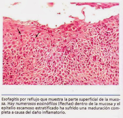 Patología 2013: ESÓFAGO