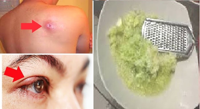 Kamu Punya Masalah dengan Bisul? Coba deh Lakukan Cara Alami berikut ...