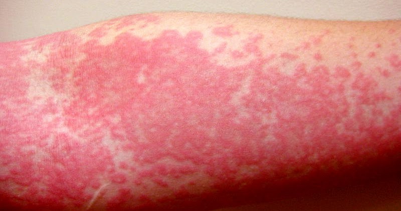 Types of urticaria (hives) - Types of physical urticaria | the dynamic ...